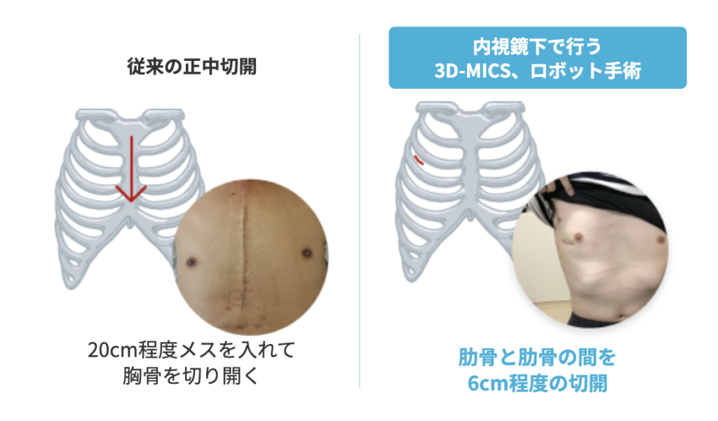 低侵襲冠動脈バイパス手術（MICS-CABG）とは ～虚血性心疾患に対する治療法を解説～ - 心臓血管外科医 下川智樹 帝京大学附属病院